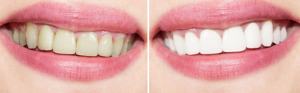 How Much Do Veneers Cost In Colorado