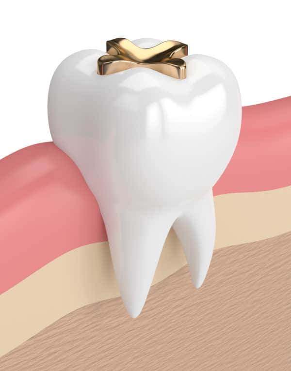 Dental Inlays Golden, CO | Dental Onlays | Indirect Fillings Denver