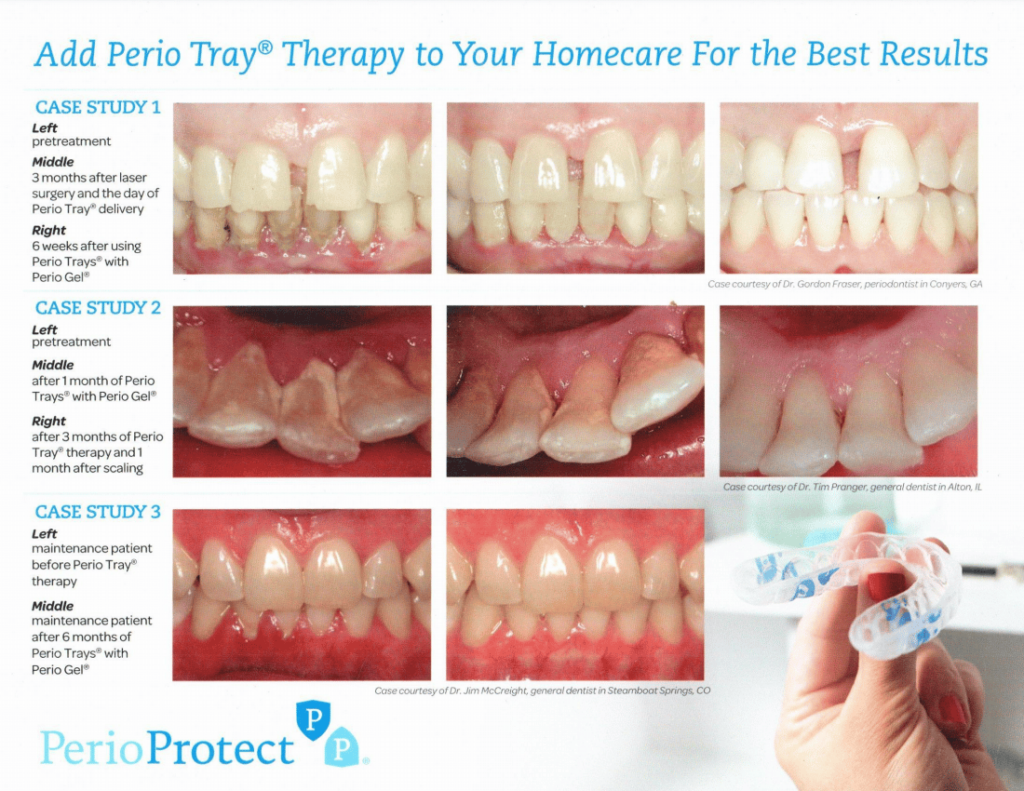 Perio Protect Golden CO - Perio Tray Therapy Lakewood CO
